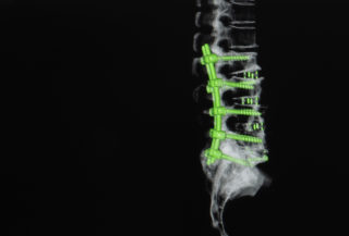 Lateral Interbody Fusion