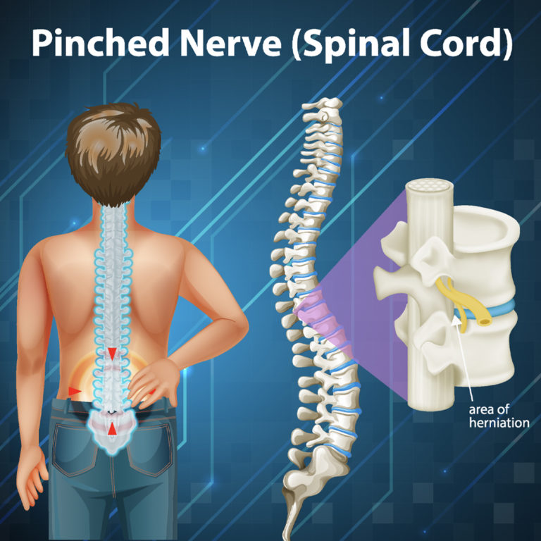 Pinched Nerve – Ashish Patel, MD