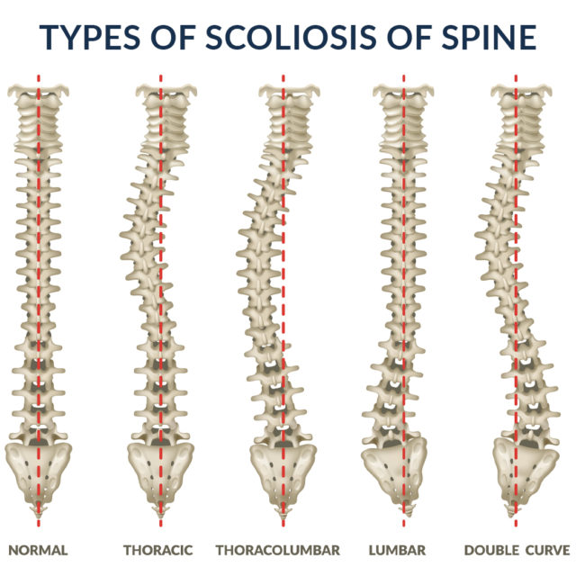 All About Scoliosis Causes Signs And Treatments Ashish Patel Md