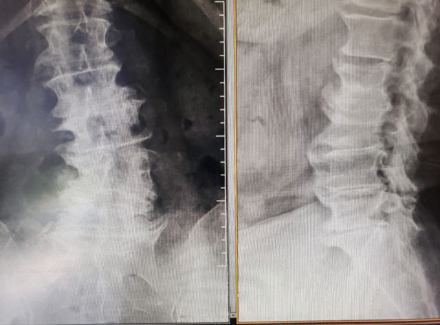 Lordosis Restoration When Using The Prone Lateral Technique – Ashish ...