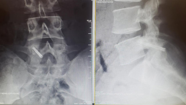 Pediatric Athlete Spine Case with Unilateral Right Pars Fracture ...