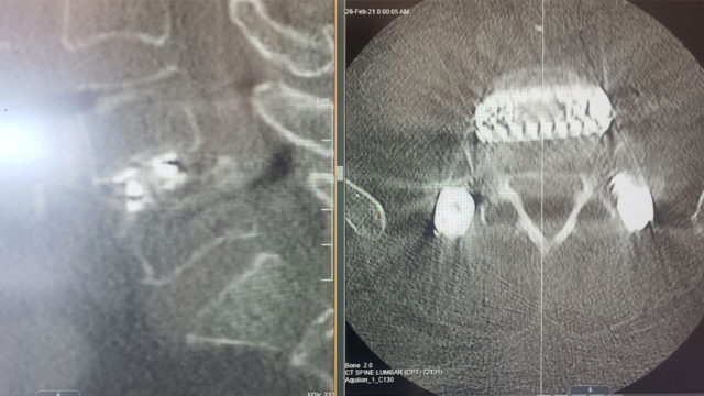 Versatility of the Prone Lateral Approach and How it Affects ...