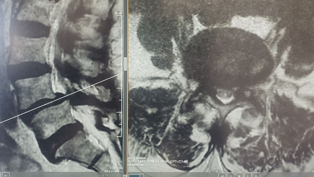 Versatility of the Prone Lateral Approach and How it Affects ...