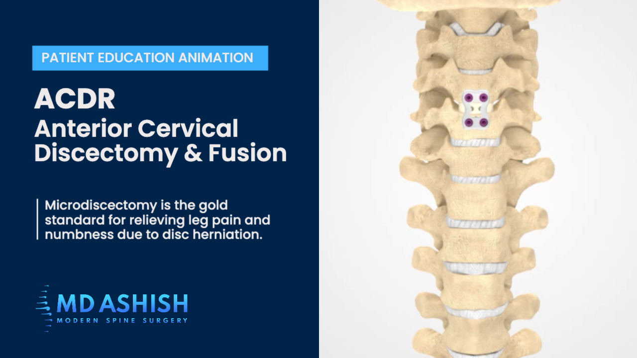 Anterior Cervical Discectomy & Fusion — Patient Animation - Ashish ...