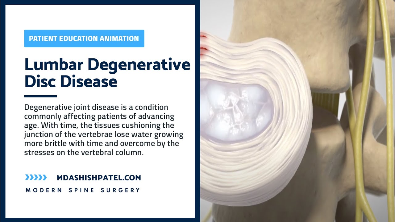 Lumbar Degenerative Disc Disease — Patient Animation - Ashish Patel, MD